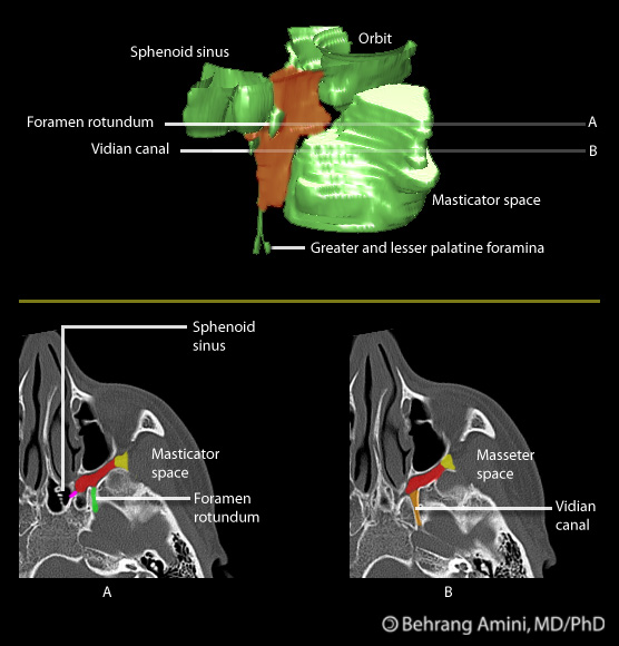 Roentgen Ray Reader: Pterygopalatine Fossa