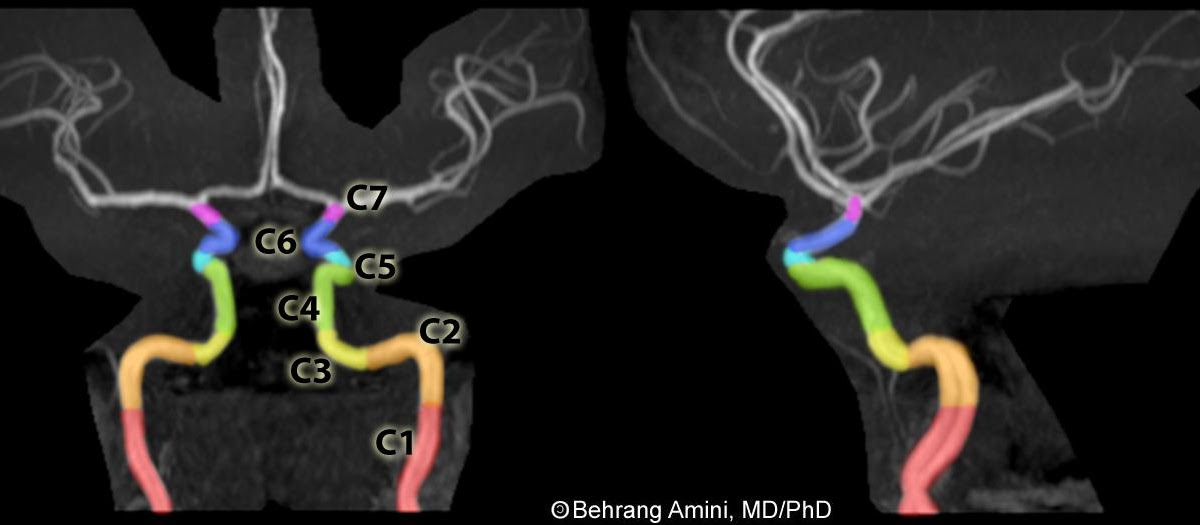 Roentgen Ray Reader: Segments of the Internal Carotid Artery