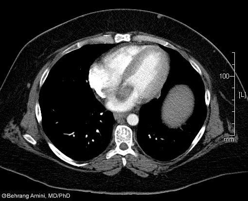 Roentgen Ray Reader Atrial Myxoma