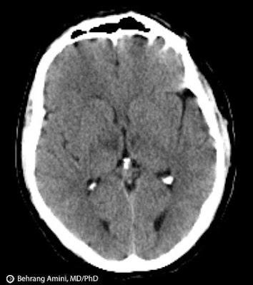 Roentgen Ray Reader: Artery of Percheron