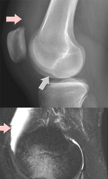 Roentgen Ray Reader: Deep Lateral Femoral Notch Sign