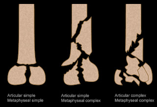 Roentgen Ray Reader: Bicondylar Intraarticular Humeral Fracture