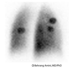 Roentgen Ray Reader: Focal Hot Spots on Ventilation/Perfusion Scan