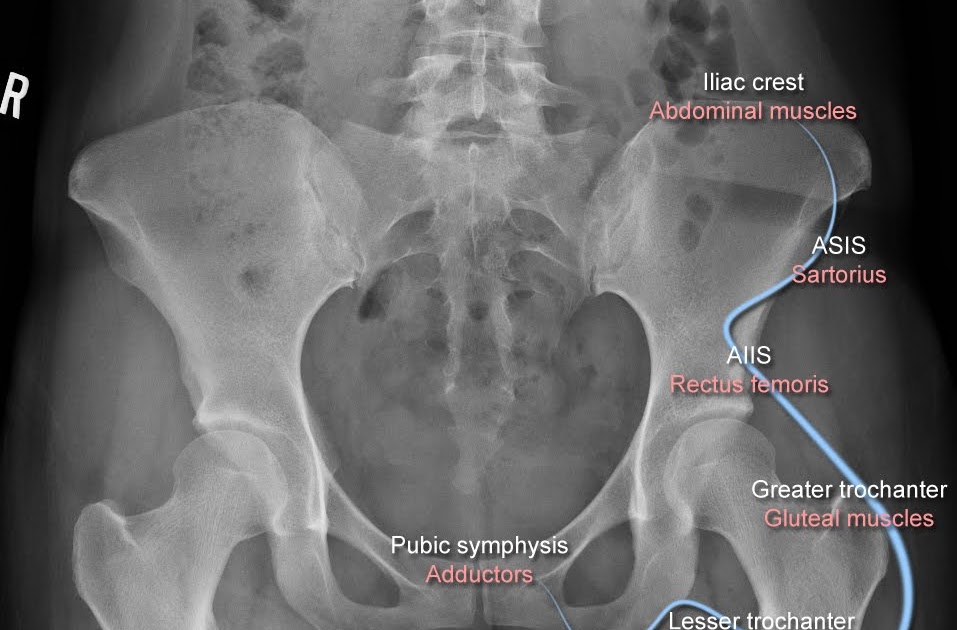Roentgen Ray Reader Pelvic Avulsion Fractures