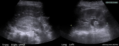 Roentgen Ray Reader: Echogenic Renal Cortex in Children