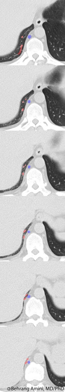 Roentgen Ray Reader: Partial Anomalous Pulmonary Venous Return