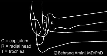 Roentgen Ray Reader: The Radial Head—Capitulum View