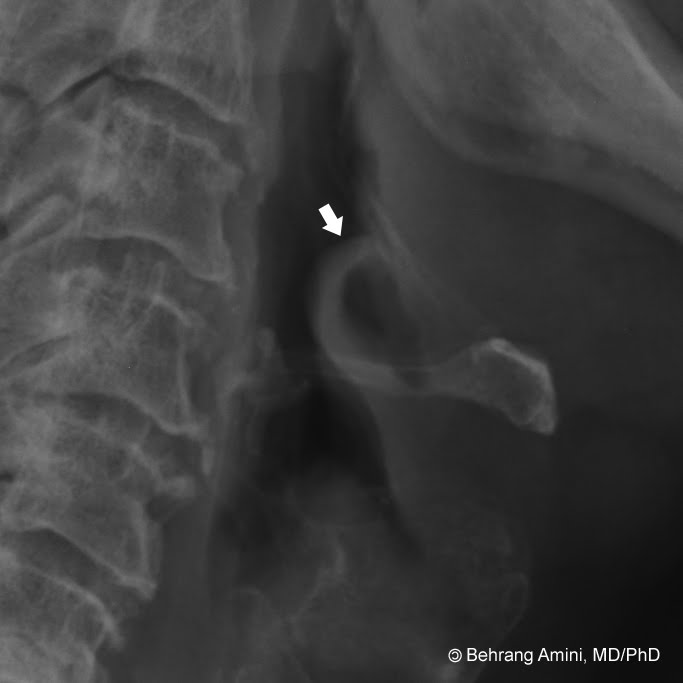 Roentgen Ray Reader: Retroverted or Curled Epiglottis