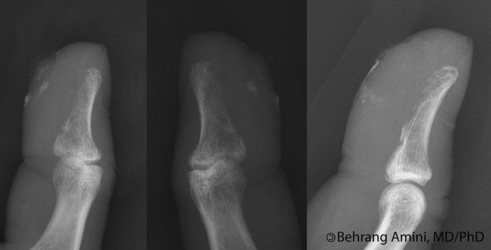 Roentgen Ray Reader: Pyogenic Granuloma and Silver Nitrate