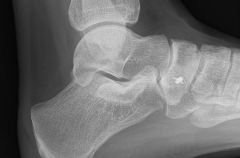 Roentgen Ray Reader Types Of Accessory Navicular Bones