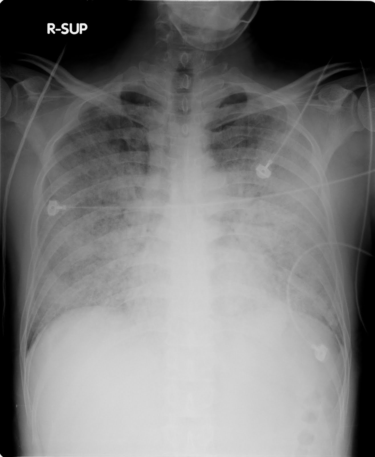CXR 胸部x光判讀 Pulmonary alveolar proteinosis (PAP)