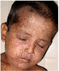 Xeroderma Pigmentosa: OBJETIVOS DEL DIAGNÓSTICO