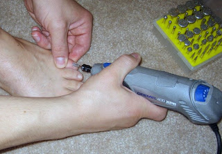 My Personal Battle with Toenail Fungus