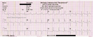 Stokes-Adams Attack | EMS 12 Lead