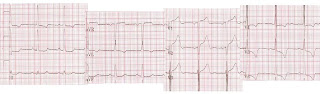 Internship.preparation: LVH/ repolarization defects vs STEMI