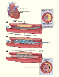 Parrott Heart: How do those stents work?