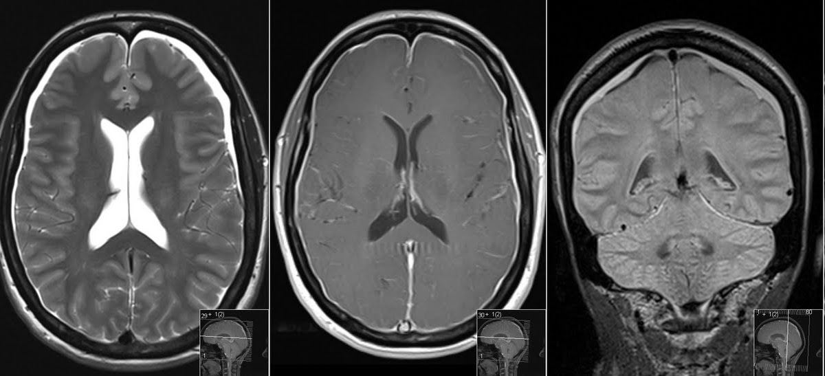 Radiology MRI: Intracranial Hypotension