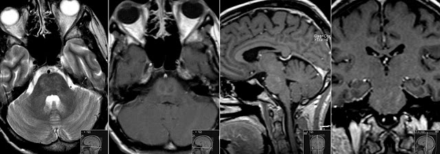 Central Pontine Myelinolysis