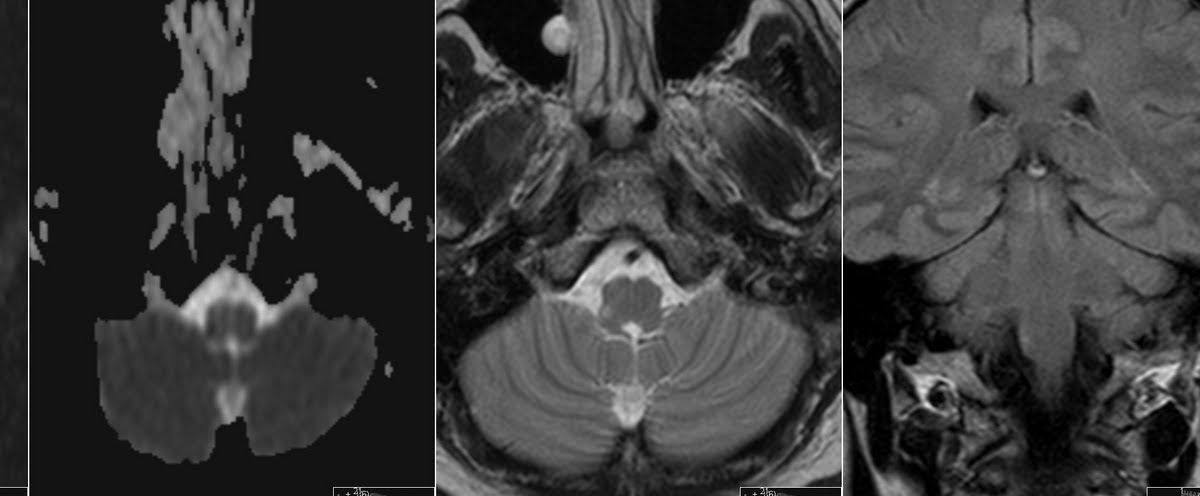 Radiology MRI: Wallenberg Syndrome - Lateral Medullary Syndrome