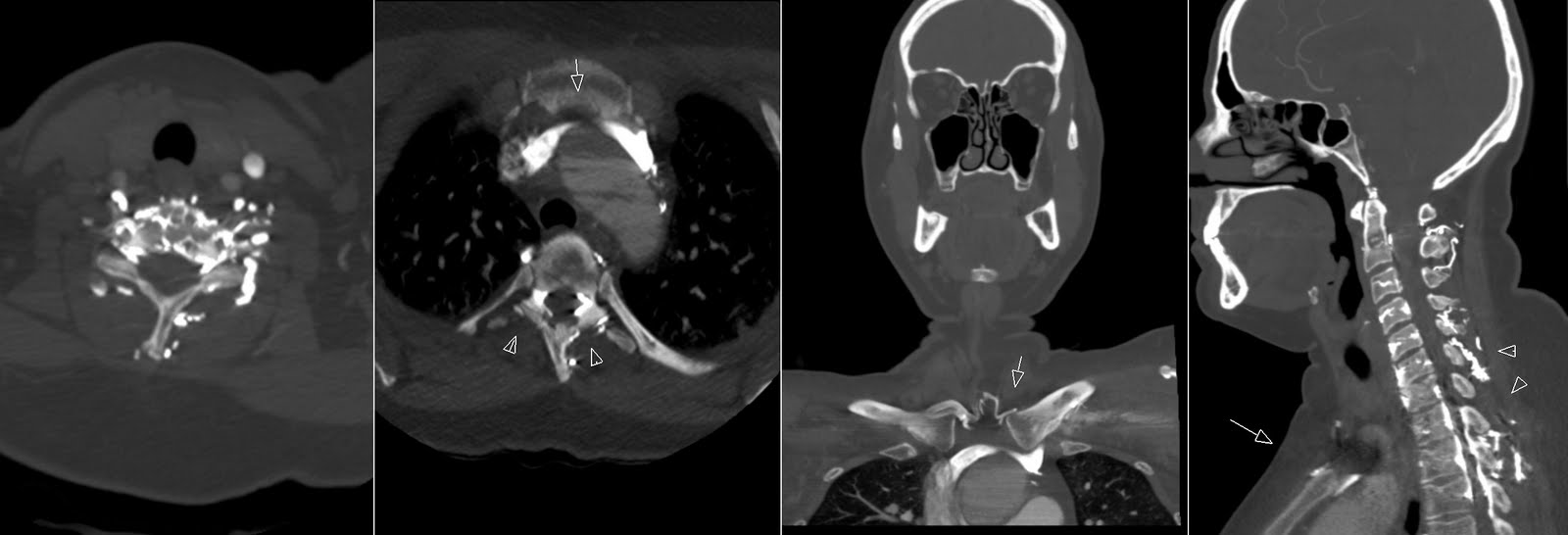 Radiology MRI: Contrast in Vertebral Venous Plexus
