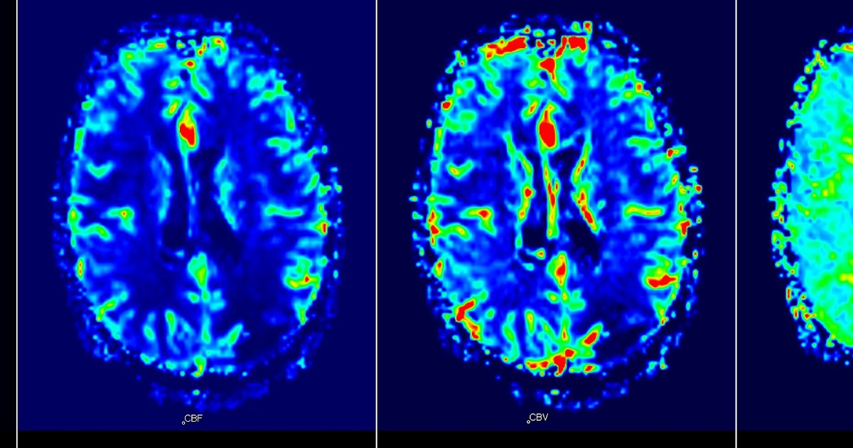 Radiology MRI: Contrast Perfusion MRI