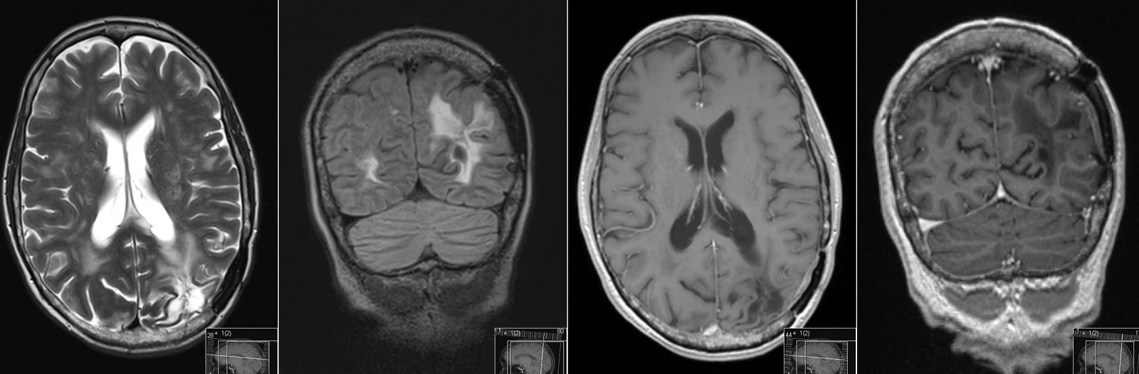 Contrast Perfusion MRI