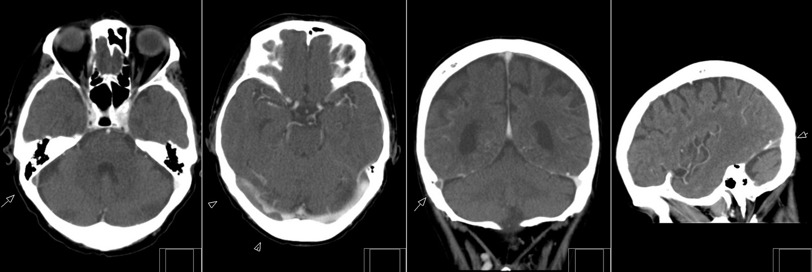 Cerebral Venous Sinus Thrombosis