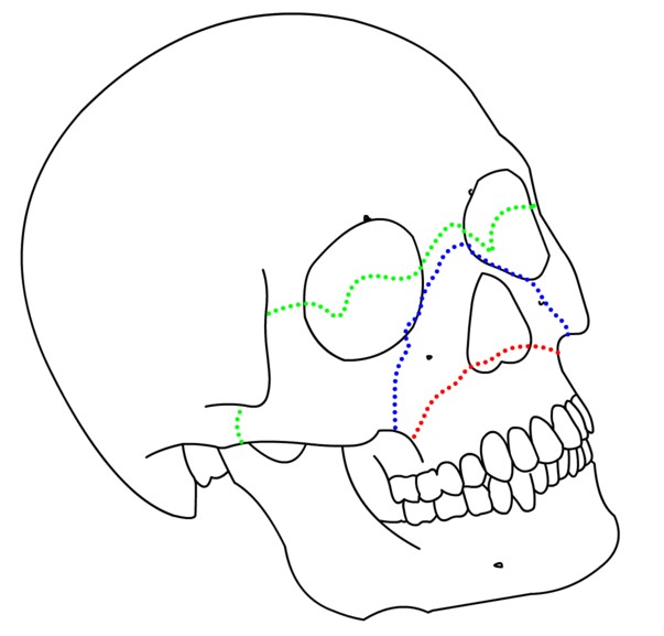 Le Fort Type 1 Fracture