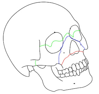 Le Fort Type 1 Fracture