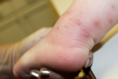 Mojoy: Gabbi Girl's ant bites.
