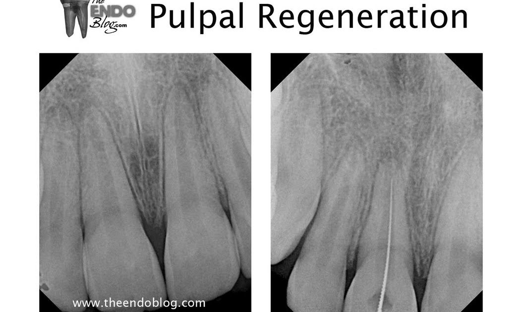 What Is The Pulpal Floor