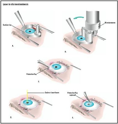 Lasik Eye Surgery, What, Why, How & Its Price | OctovianaBlog