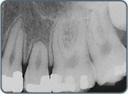 Aula Virtual Ortodoncia 3: REABSORCION RADICULAR EN ORTODONCIA