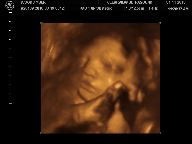 The Wood Family: 3D Ultrasound at 33 weeks