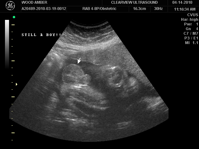 The Wood Family: 3D Ultrasound at 33 weeks