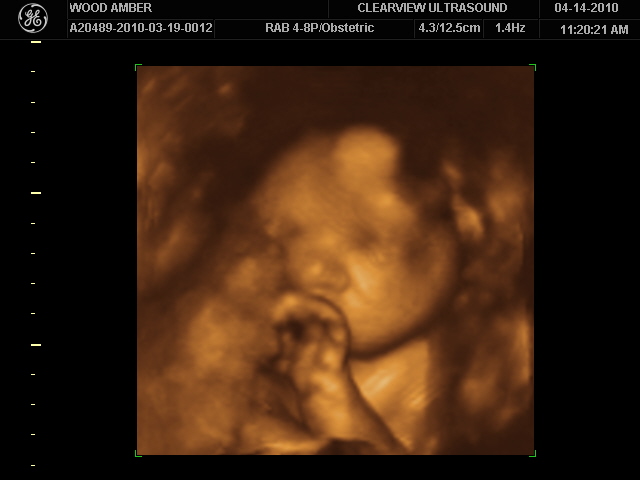 The Wood Family: 3D Ultrasound at 33 weeks