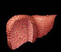 SIROSIS HEPATIS (SH)