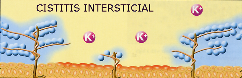 UROCIR: Todo un Reto: Cistitis Intersticial