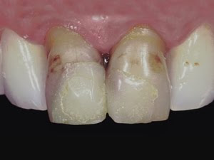 Prótese Dentária: Murilo Calgaro: Uma nova visão de extratificação