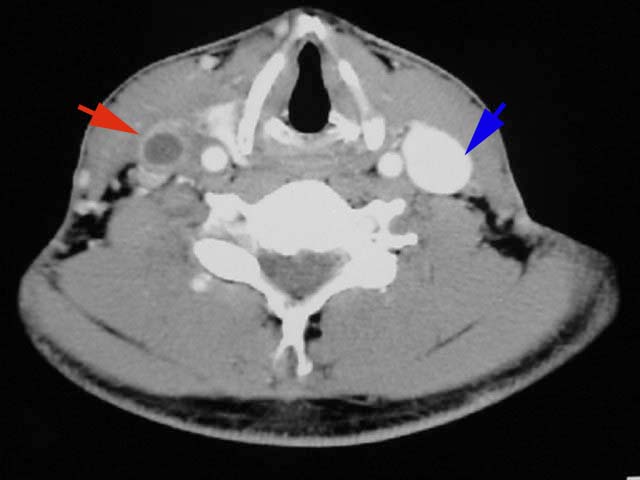 Lemierre's Syndrome on CT Scan ~ signs and symptoms of throat cancer ...