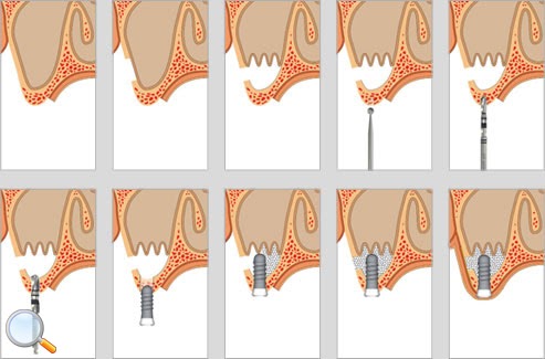 "Sinus Lift" Procedure - The Return of Intra-Oral Sinus Surgery ...