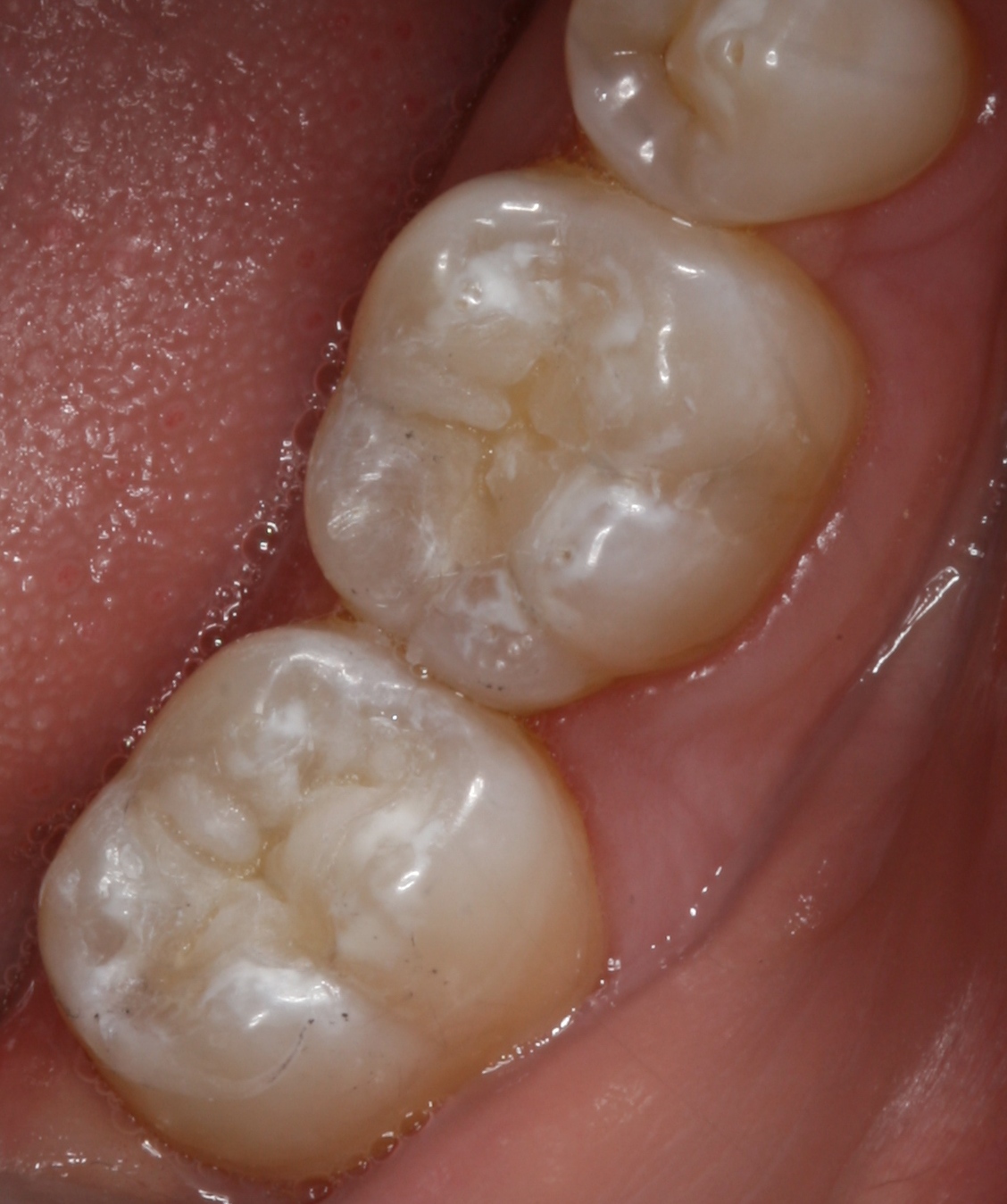 Dr. Workman, DDS: Inlays and Onlays