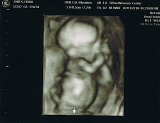 .: 15 Week Ultrasound