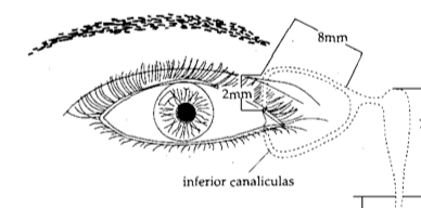 Oral Maxillofacial surgery: Tear lacrimal canaliculi injury