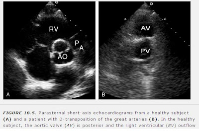 cardiology: ABNORMALITIES OF RIGHT VENTRICULAR INFLOW