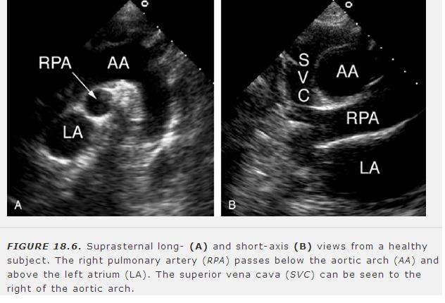 cardiology: ABNORMALITIES OF RIGHT VENTRICULAR INFLOW