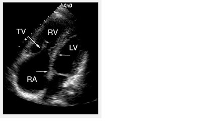 cardiology: ABNORMALITIES OF RIGHT VENTRICULAR INFLOW