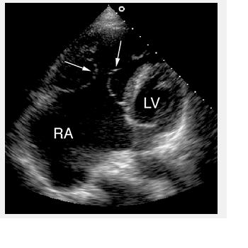 cardiology: ABNORMALITIES OF RIGHT VENTRICULAR INFLOW