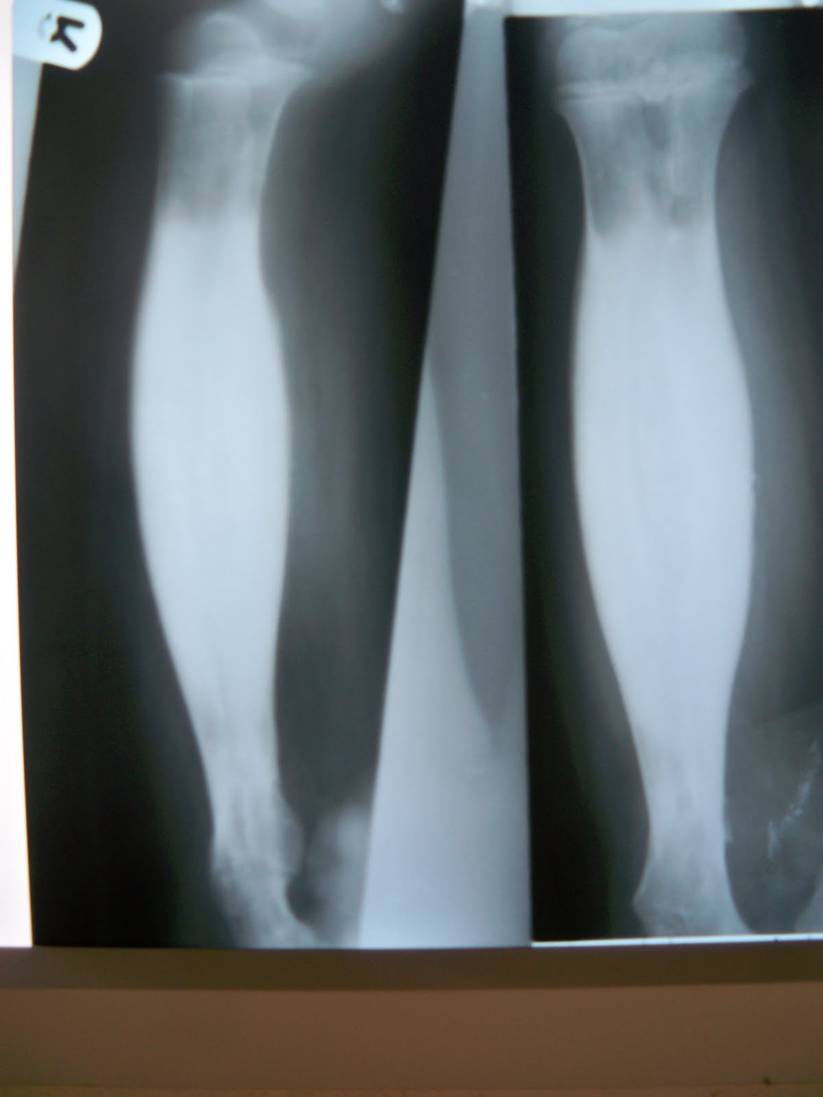 The Medical MacGyver: The case of the patient with the new leg