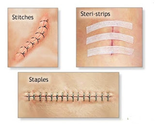 PERFECT FIRST: STITCHES